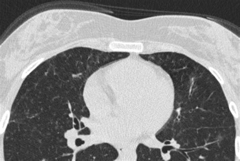 Structure Subsegmental Bronchi Lungs