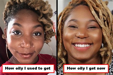 31 Ways To Help Get Rid Of A Pimple In A Hurry