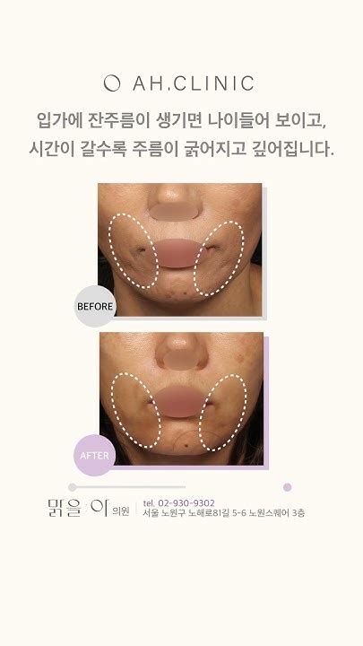 입가 주름도 펴고 피부 콜라겐 재생까지 맑을아 의원에서는 가능합니다 입가주름 치마주름 상어주름 입가노화 베이비