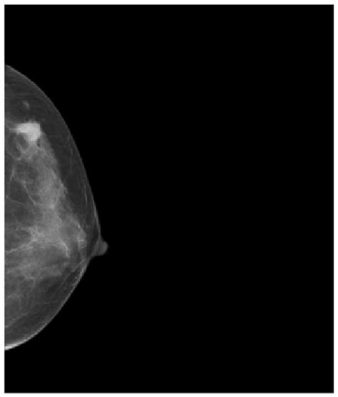 Irregular Nodular High Density Shadow On The Upper Outer Quadrant Of Download Scientific