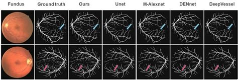 Visualization Of Retinal Vessel Segmentation Based On Fundus Photos