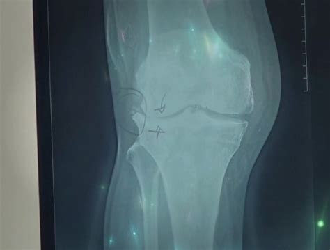 Por Iniciar Una Colocación De Prptesis De Rodilla Deformidad En Valgo By Unidad De Rodilla