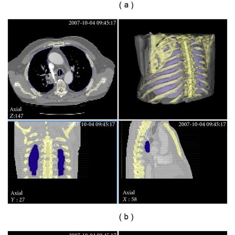 Three Stages Of Preprocessing To Generate Context For Subsequent Lung