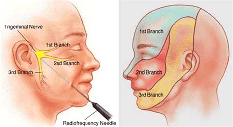 Medical Videos Ppt And Lecture Notes Trigeminal Neuralgia
