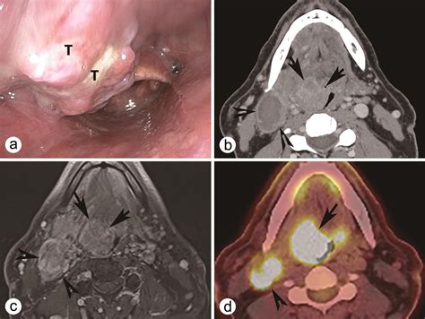 Oropharynx Hpv