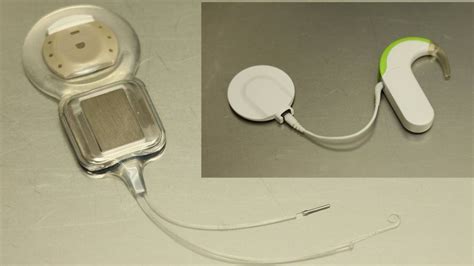 Can Cochlear Implants Slow Dementia In Older Adults Mayo Clinic News