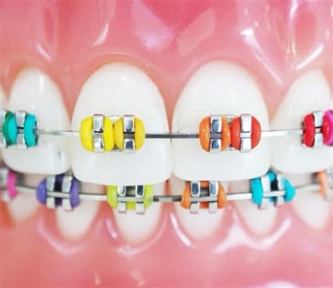 Braces Sharrow Vale Dental Care
