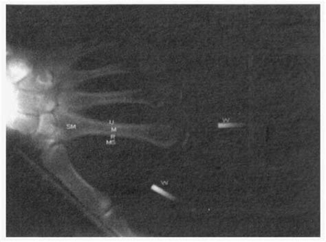 Second Metacarpal Bone Density Determinations Sm Second Metacarpal