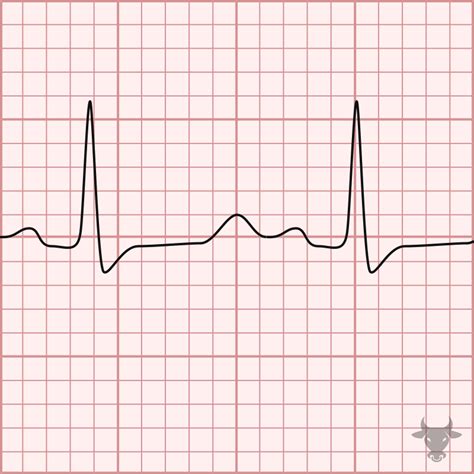 Prolonged Qt Ecg Stampede