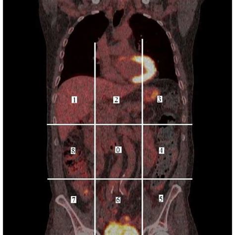 Simplified Pci Used For Scoring The Radiological Pci Download