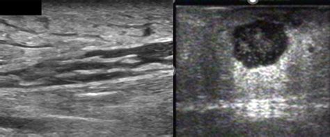 Point Of Care Ultrasound Differentiating Cellulitis Vs Abscess Gulfcoast Ultrasound News Blog