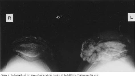 Figure 1 From Bilateral Subcutaneous Patellar Calcifications And Unilateral Bursitis In