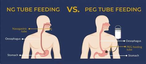 Peg Tube Vs G Tube E Phlebotomy Training