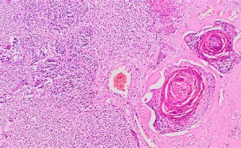 Photomicrography From Cervical Malignant Mixed Mullerian Tumor Uterine Download Scientific