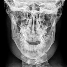 Broken Jaw X Ray Orthognathic Surgery In London Harley Street