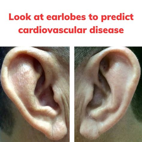Look At Earlobes To Predict Cardiovascular Disease