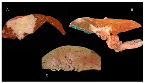 Cholangiocarcinoma Staging