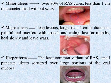 Ulcerative Lesions