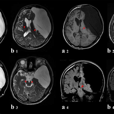 Left Arachnoid Cyst After Abdominal Drainage The Left Frontal Download Scientific Diagram