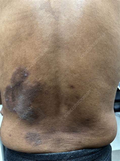 Ringworm Stock Image C0606825 Science Photo Library