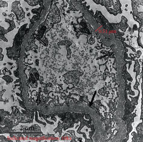 A B Electron Microscopy Of The Renal Biopsy In The Proband Iii 10 Download Scientific