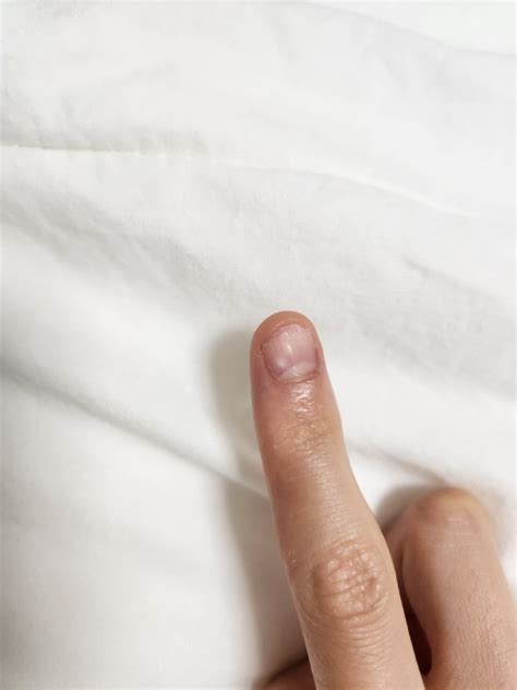 손톱에 하얀점이 생겼는데 이거뭔가요 지식in