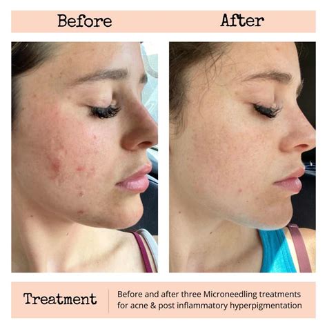 Professional Microneedling Scottsdale Acne Scars Wrinkles And Pigment