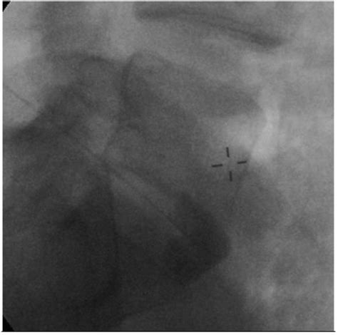 Superior Hypogastric Plexus Block With Contrast Spread In A Lateral Download Scientific Diagram