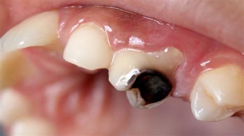 What Is The Black Stuff On My Teeth Detroit Chinatown