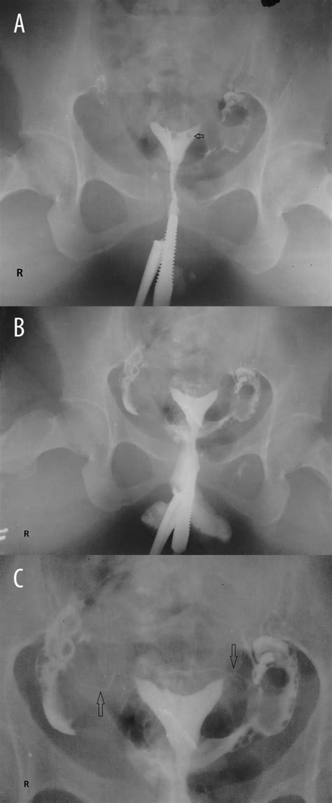 Contrast Intravasation During Hysterosalpingography Pmc