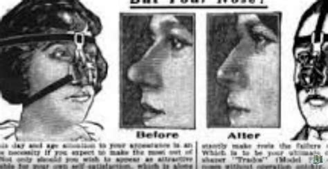 100 200 Years Previous Non Surgical Nose Reshaping Apparatus