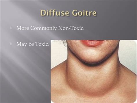 Diffuse Toxic And Endemic Goiter Ppt Thyroid Disorders Endocrine And Metabolic Diseases