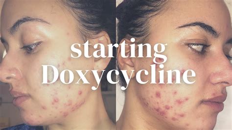 Tretinoin Before And After Acne