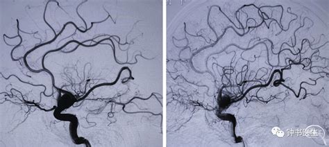 中枢介入第373期：tb治疗大脑中动脉夹层动脉瘤 脑医汇