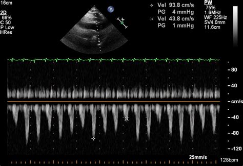 Pedi Cardiology Echo Features Of Tamponade
