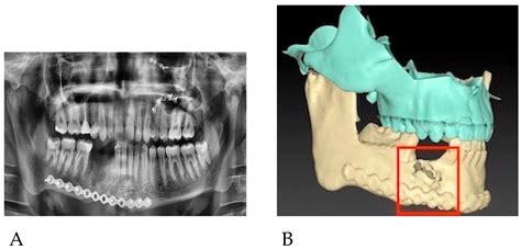 Mandibular Fracture X Ray
