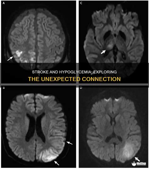stroke and hypoglycemia exploring the unexpected connection medshun