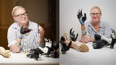 The Future Of Prosthetics A Breakthrough In Bionic Hand Technology