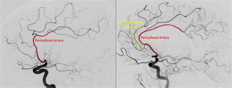 Anatomy Of The Intracranial Arteries Neuroimaging Clinics