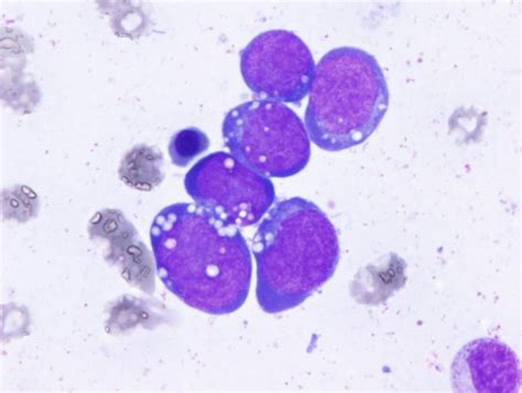 Burkitt Lymphoma