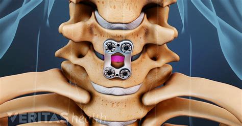 potential risks and complications of acdf surgery
