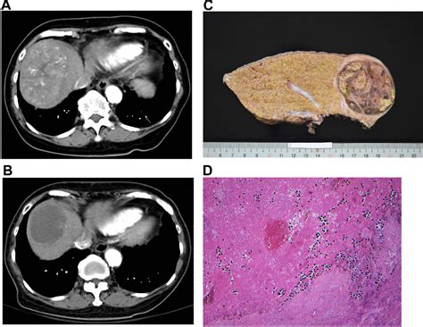 Table 1 From Yttrium 90 Radioembolization As The Major Treatment Of Hepatocellular Carcinoma