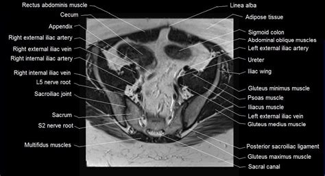 Female Pelvis Anatomy Free Axial Cross Sectional Anatomy Of Female Pelvis