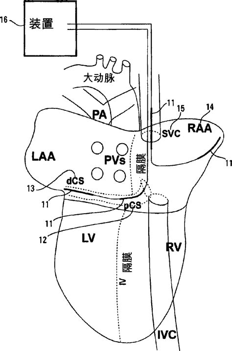 Method And Device For Low Energy Termination Of Atrial Tachyarrhythmias Eureka Patsnap