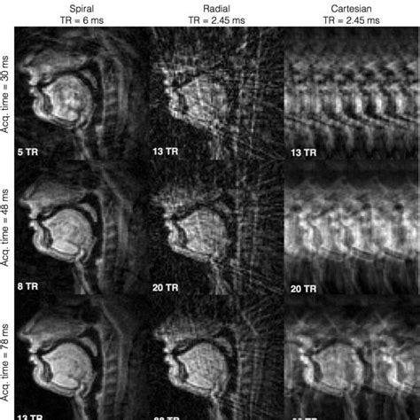 Simulated Aliasing Artifacts For Spiral Radial And Cartesian Download Scientific Diagram