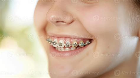 Braces On Teeth Beautiful Red Lips And White Teeth With Metal Braces A