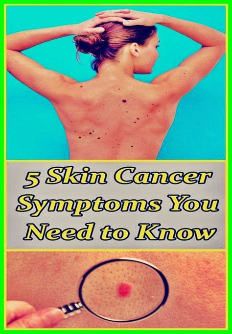 5 Skin Cancer Symptoms You Need To Know This Summer Artofit