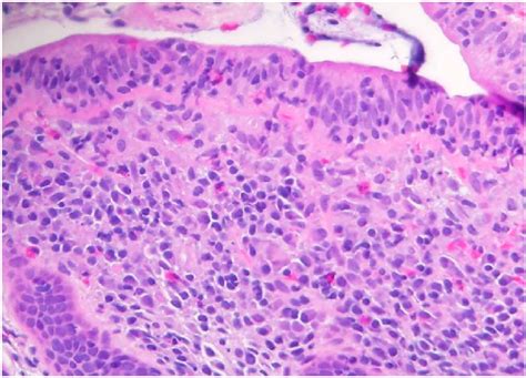 403 Random Colon Higher Magnification Showing A Marked Increase In Download Scientific