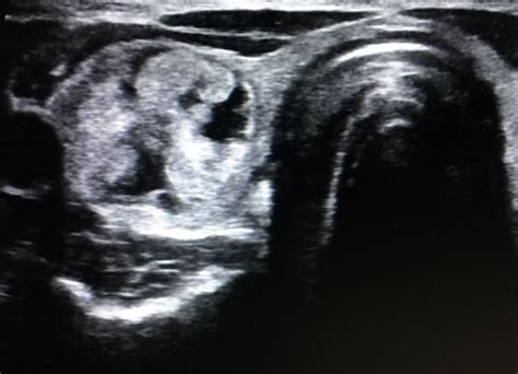 Colloid Nodule With Degeneration