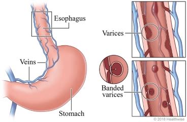 Hepatitis B And C Treatment Expert Hepatitis Care And Advanced